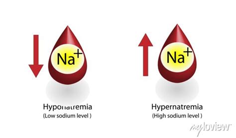 Hypernatremia High Plasma Sodium Level And Hyponatremia Low Cartazes Para A Parede • Posters