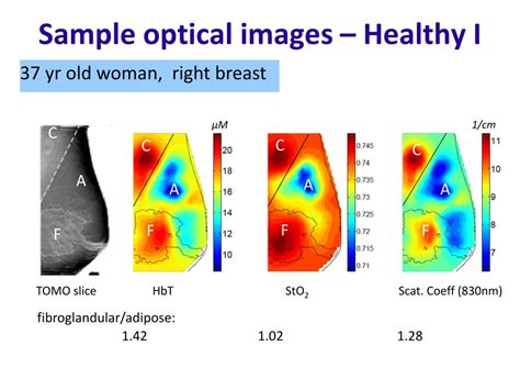 Ppt 3d Optical Imaging And Digital Xray Of Breast Lesions Powerpoint Presentation Id 2004416