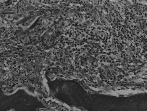 Computed Tomography Showing Compression Of The Left L3 Nerve Root By
