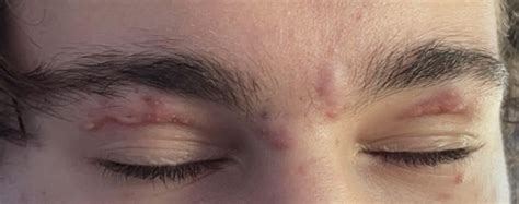 18 Yo Male Clustered Pustular Lesions On Bilateral Eyelids X 9 Months