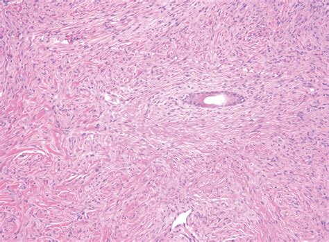 Mobile Enlarging Scalp Nodule Mdedge Dermatology