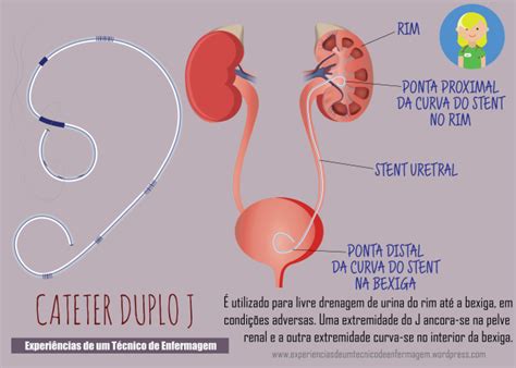 Cateter Duplo J Experiências De Um Técnico De Enfermagem Enfermagem