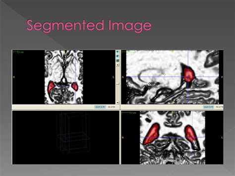 Ppt Segmentation In Itk Snap Powerpoint Presentation Free Download