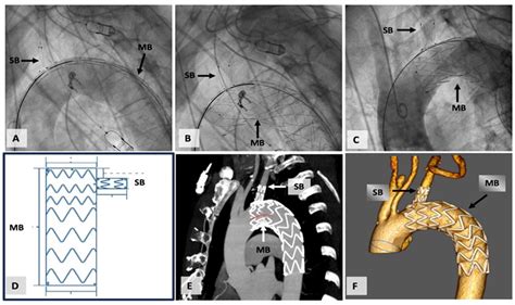 A Type B Aortic Dissections With False Lumen Fl And True Lumen Tl Download Scientific