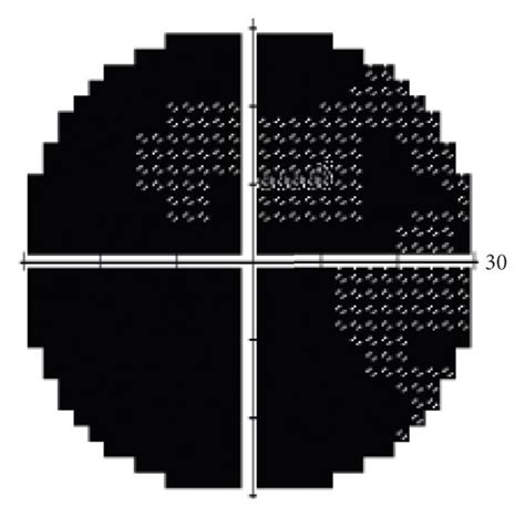 Color Fundus Photographs And Corresponding Visual Fields Obtained From Download Scientific