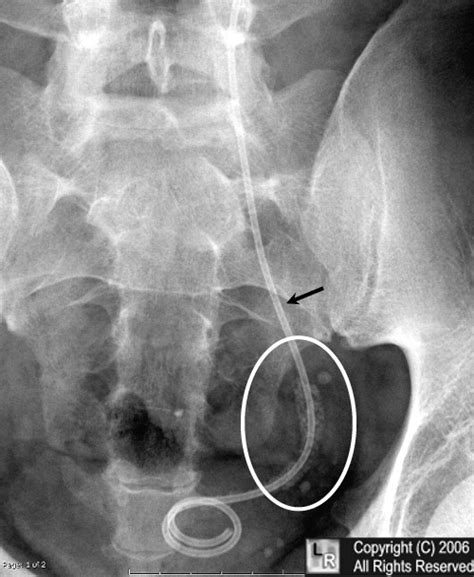 Learning Radiology Steinstrasse