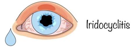 Get To Know Uveitis And How To Code The Diagnosis Optometryophthalmology Coding