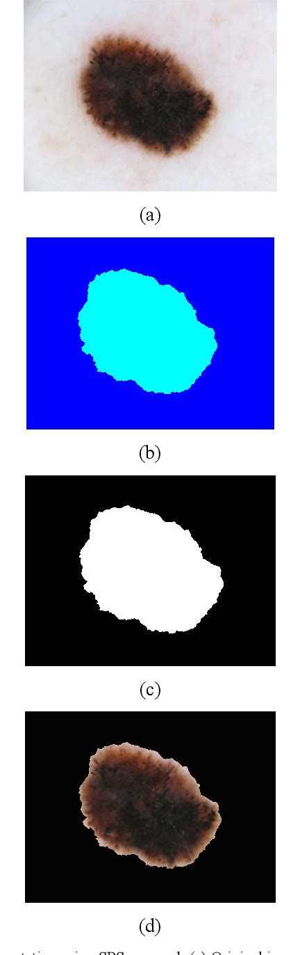 Figure 1 From Lesion Segmentation In Dermoscopic Images Using Superpixel Based Fast Fuzzy C