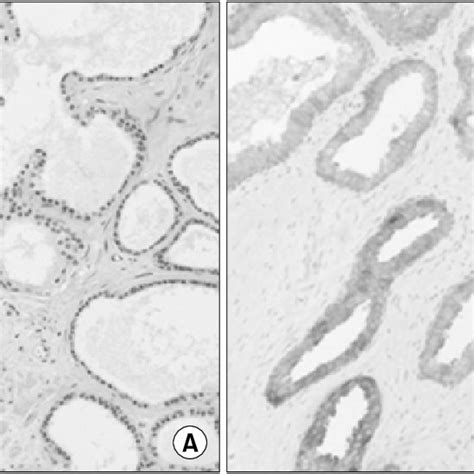 The Midline Prostatic Cyst Is Positioned Intravesically And Anteriorly Download Scientific