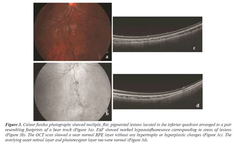 Pigmented Retinal Lesions