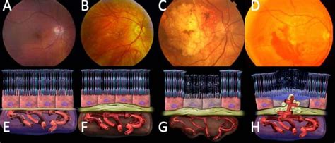 Dry Age Related Macular Degeneration
