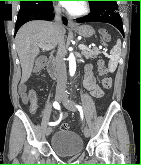 Ischemic Colitis Ct Angiogram At Willard Madrigal Blog