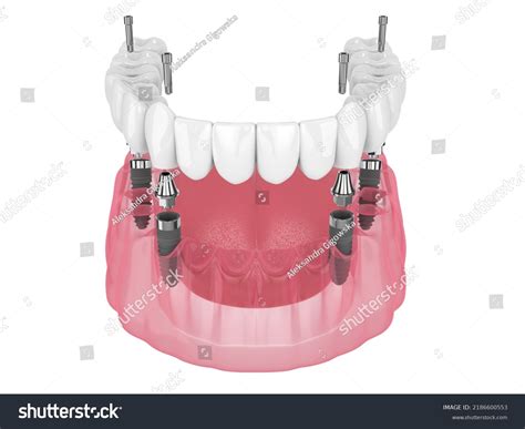 3d Render Mandibular Prosthesis All On Stock Illustration 2186600553 Shutterstock