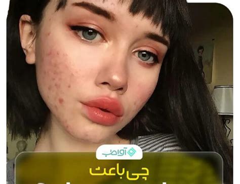 چه چیزهایی باعث جوش زدن پوست می شوند؟