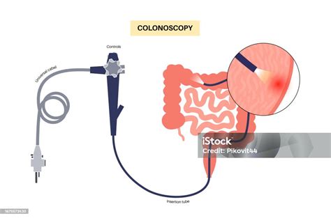 Colonoscopy Medical Procedure Stock Illustration Download Image Now Colon Polyp Adenoma