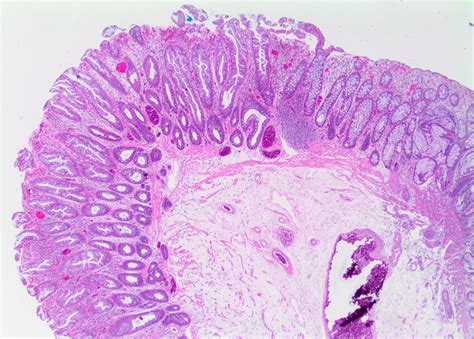 Low Magnification View Of The Hyperplastic Polyp Epithelial Serration