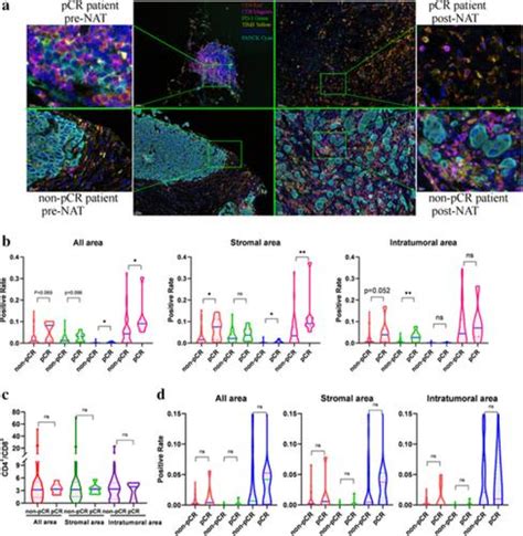 定量多重免疫荧光分析将浸润的 Pd1cd8 和 Cd8t 细胞鉴定为对乳腺癌新辅助化疗反应的预测。thoracic Cancer