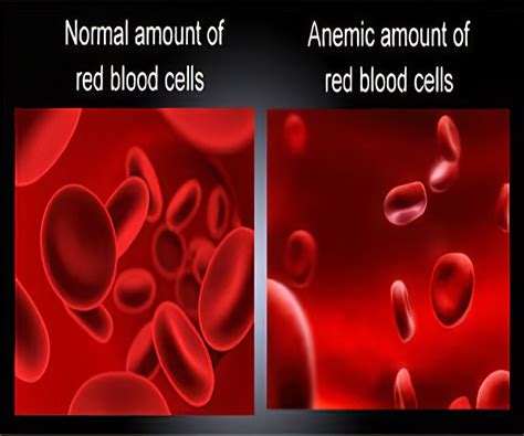 Anemia Low Hemoglobin Haemoglobin Causes Symptoms 42 Off