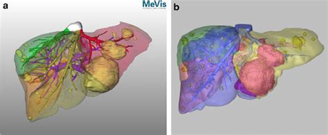 Liver Reconstruction Pat Id 10 External Reconstruction A Download Scientific Diagram