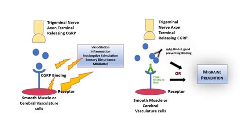 Migraine Latest Disease And Treatment Updates Clinical Pain Advisor