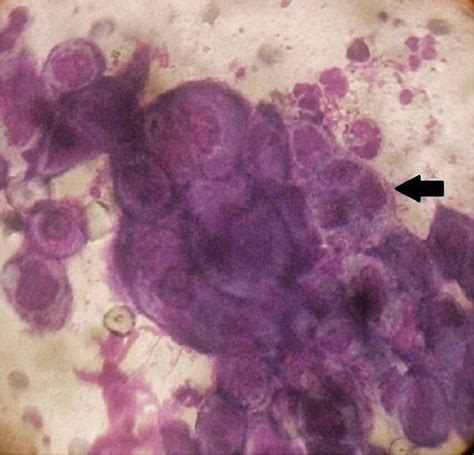 Demonstration Of Tzanck Smear And Its Significance In Dermatology