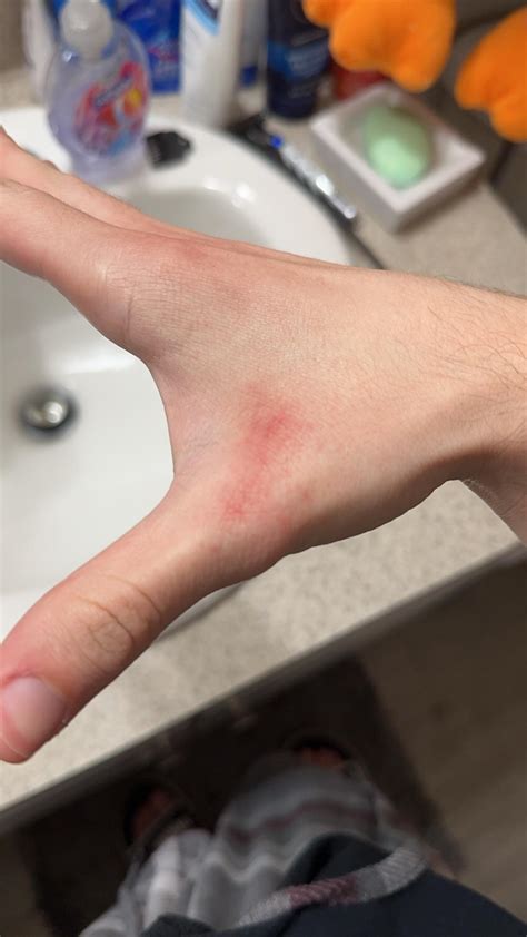 Why Does My Skin In This Area Always Turn Red After Masturbation R DermatologyQuestions