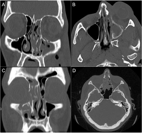 High Resolution Ct Images Acquired With Bone Algorithm And Windowed On High Resolution Ct Images Acquired With Bone Algorithm And Windowed On