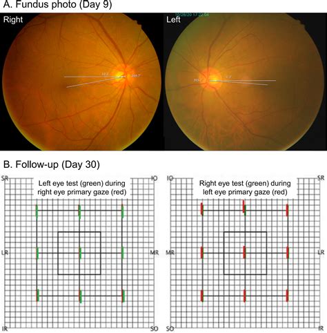 Superior Oblique Palsy As The Initial Manifestation Of Anti Contactin 1 Igg4 Autoimmune