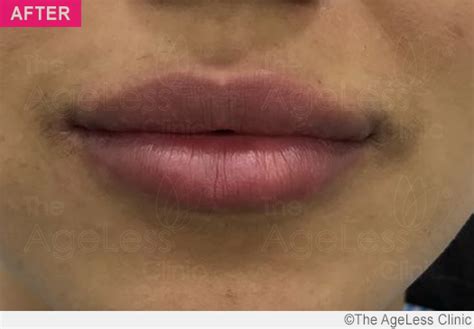 All About Laser Lip Lightening Effects Cost Risks