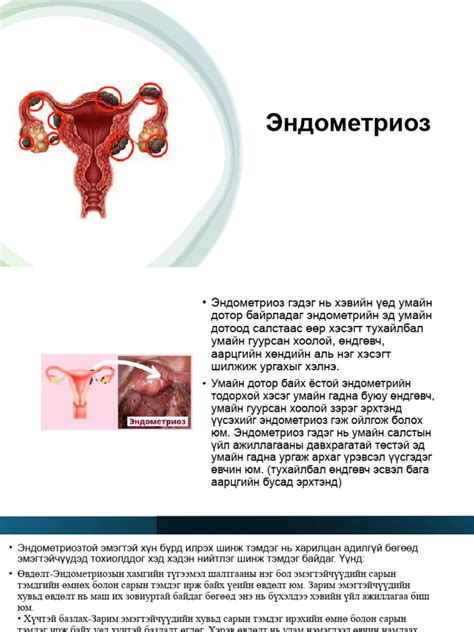 эндометриоз Pdf