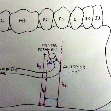 Pdf Assessment Of The Anterior Loop Of The Mandibular Canal Using Cone Beam Computed