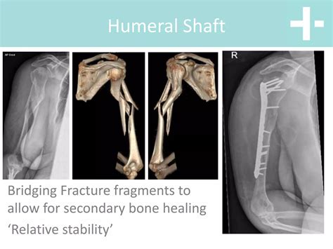 Fractures Why Fix It Like That Pptx