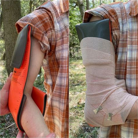 Splinting Upper Limb Fractures Using A Splint Kit Rhinorescue