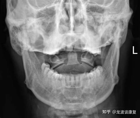 寰枢椎半脱位是什么如何治疗寰枢椎半脱位 知乎
