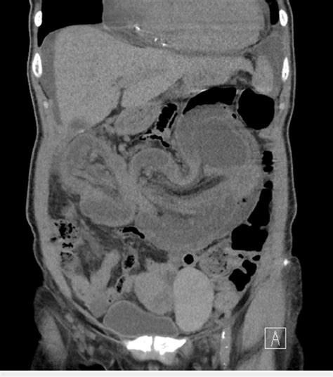 Coronal Slice Of The Ct Of The Abdomenpelvis Demonstrating A Large