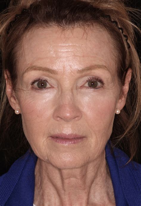 Fig 13 Static Lines Before Treatment Oral Health Group