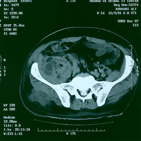 Section Of The Appendix Hyperplasia Of The Lymphatic Tissue Is Evident Download Scientific