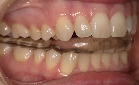Splint For Anterior Open Bite Distortion Elizabeth Caughey