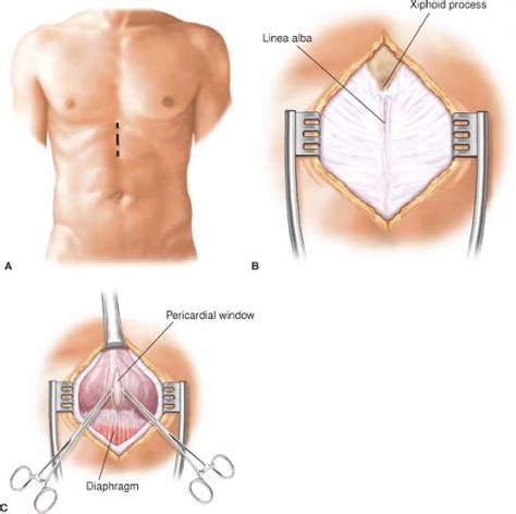 Subxiphoid Pericardial Window