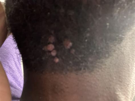 How To Get Rid Of It R Folliculitis