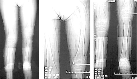Simultaneous Femoral And Tibial Lengthening In Combined Congenital