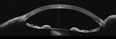 [oct Observations] Utilizing Full Range Anterior Chamber Scans In The Management Of Glaucoma