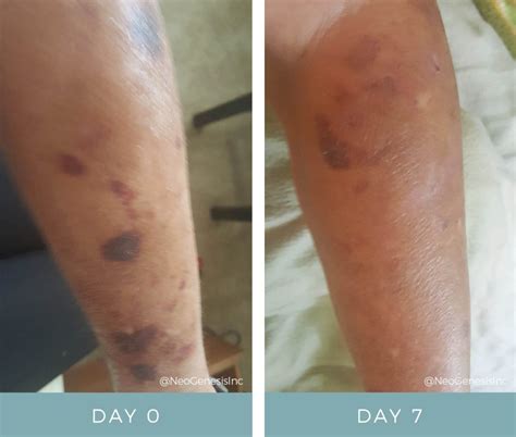 Senile Purpura Cream