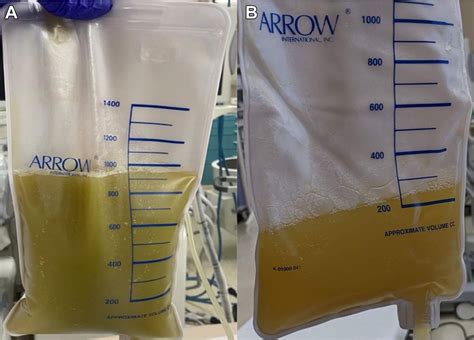 A 69 Year Old Man With Rheumatoid Arthritis And Pleural Effusion