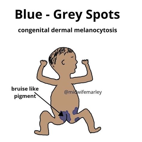 Midwife Blue Grey Spots Congenital Dermal Melanocytosis Are A Kind