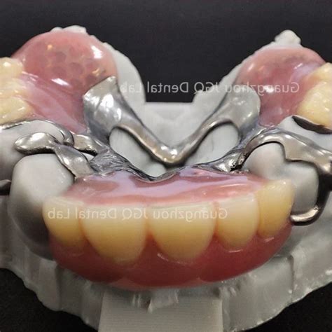 Removable Metal Framework Dentures Cobalt Chromium Alloy Support