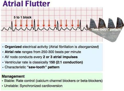 Atrial Flutter Is A Supraventricular