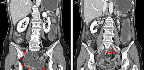 A Contrast Enhanced Coronal CT Image Showing A Closed Loop Download Scientific Diagram