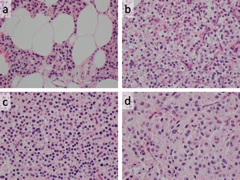 Parathyroid Adenoma Histology