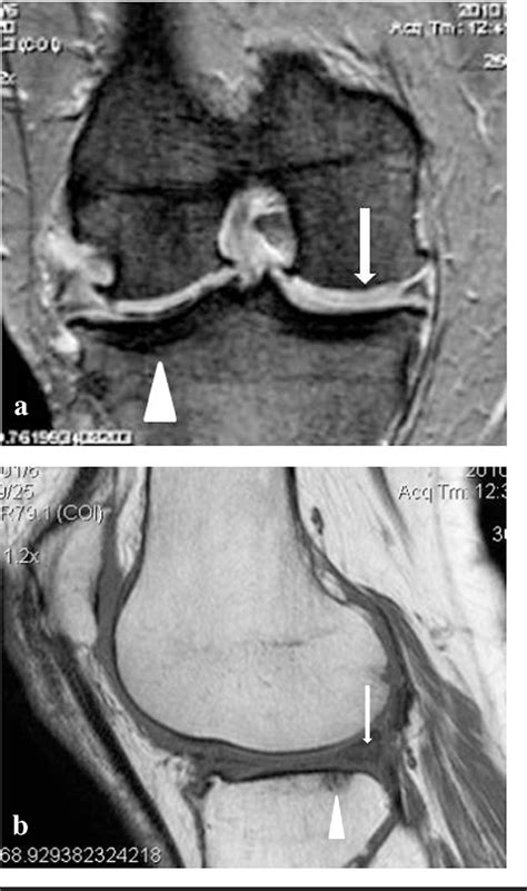 Chondrocalcinosis